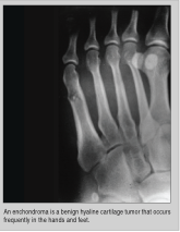 Differentiating Between Benign And Malignant Bone Tumors