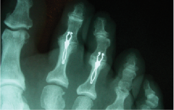 Current And Emerging Insights On Hammertoe Correction