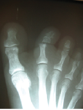 Current And Emerging Insights On Hammertoe Correction