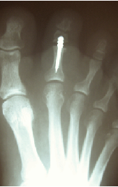 Current And Emerging Insights On Hammertoe Correction
