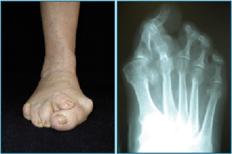 Lesser Metatarsalgia: Are Lesser Metatarsal Osteotomies Necessary?