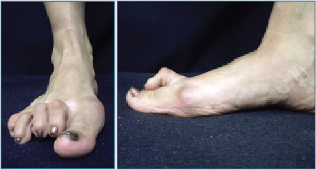 Lesser Metatarsalgia: Are Lesser Metatarsal Osteotomies Necessary?