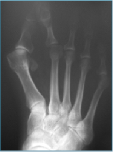 Lesser Metatarsalgia: Are Lesser Metatarsal Osteotomies Necessary?