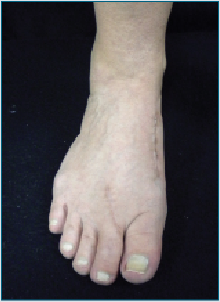 Lesser Metatarsalgia: Are Lesser Metatarsal Osteotomies Necessary?