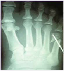 Pertinent Pearls On Fifth Metatarsal Osteotomies
