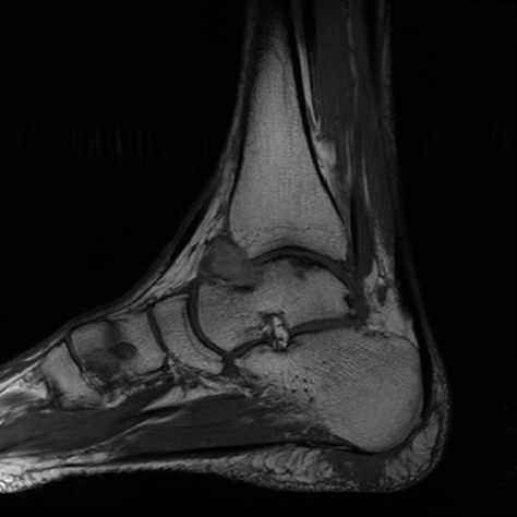 Keys To Diagnosing Metastatic Melanoma In The Foot And Ankle