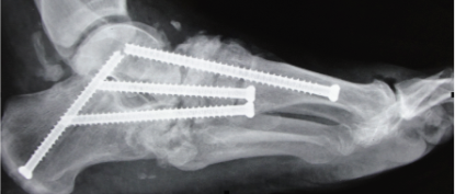 Charcot Foot Reconstruction