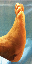 Emerging Evidence On Treatment Of The Diabetic Charcot Foot