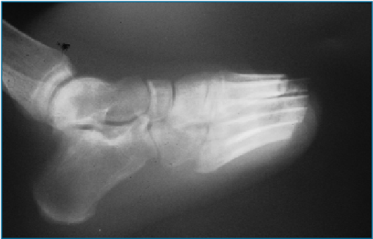 Understanding The Biomechanics Of The Transmetatarsal Amputation