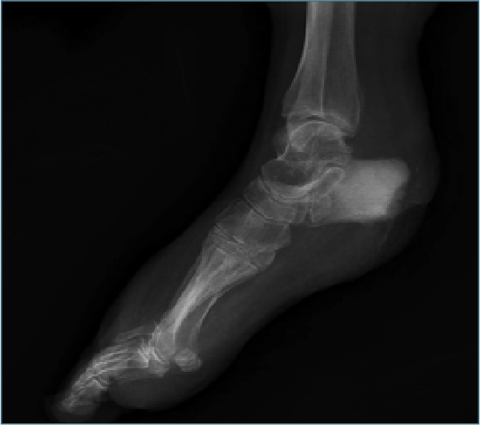 Managing Pressure Ulcers In The Lower Extremity