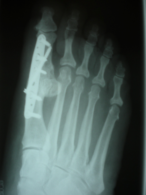 Key Insights On Performing A Revisional Positional First MPJ Arthrodesis
