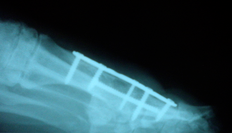 Key Insights On Performing A Revisional Positional First MPJ Arthrodesis