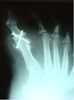 Treating Undiagnosed Charcot Neuroarthropathy Following Traumatic ...