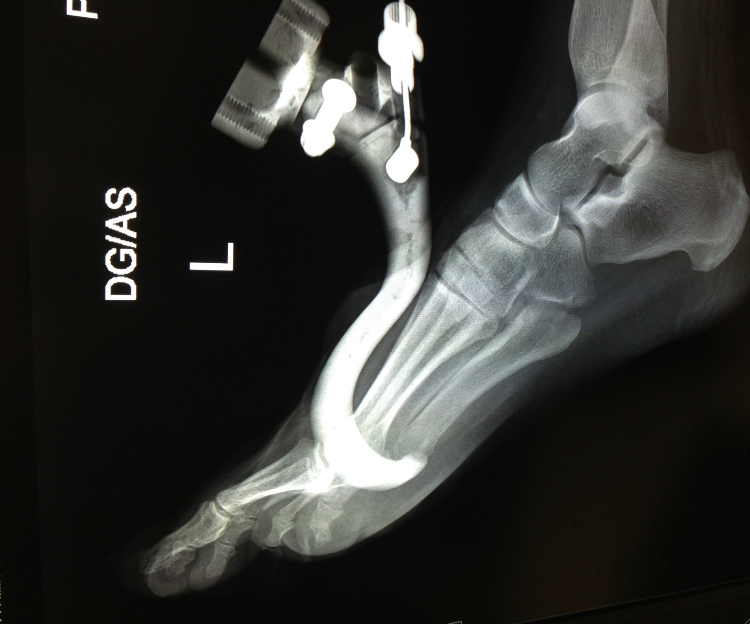 Managing Traumatic Foot Wounds From Foreign Objects