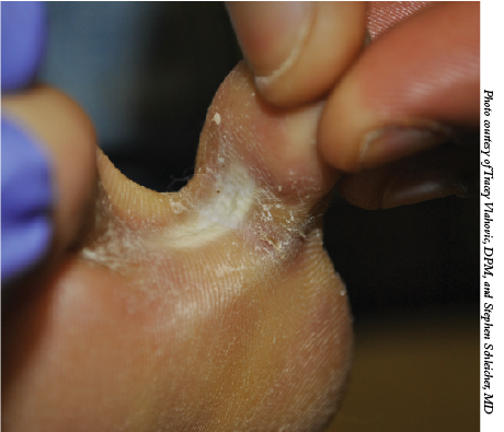 Interdigital Tinea Pedis