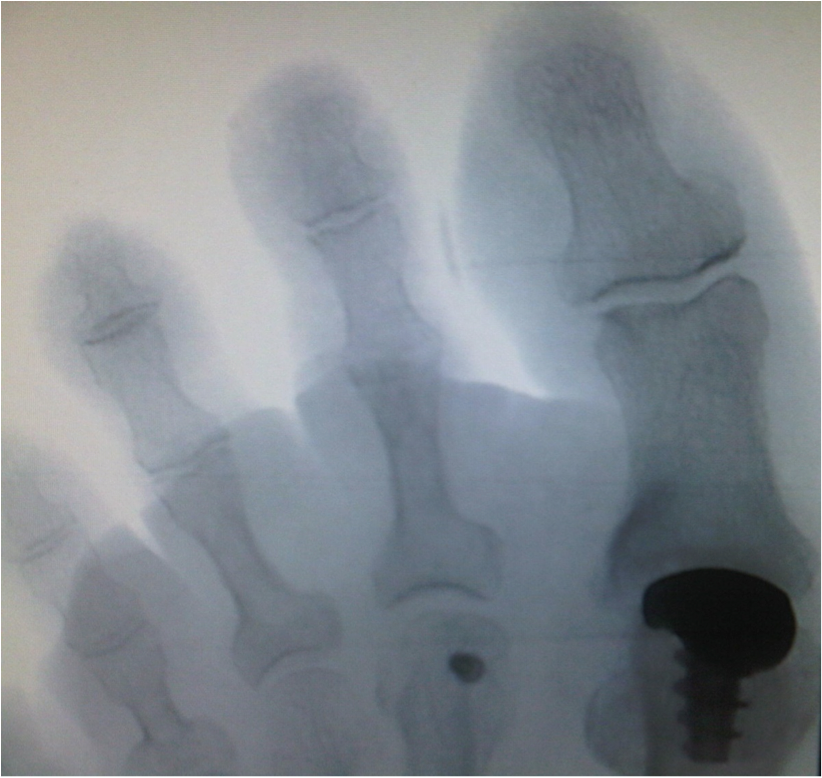 Current Insights On First MPJ Implants