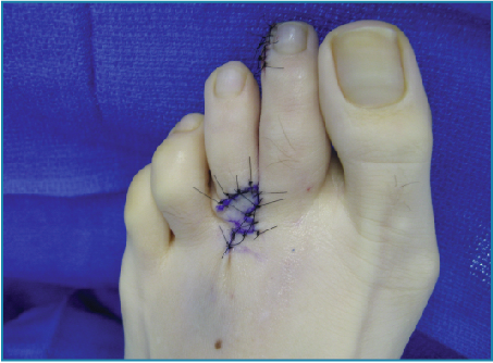A Guide To Using Bilobed Flaps In Lower Extremity Surgery