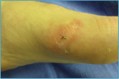 A Guide To Using Bilobed Flaps In Lower Extremity Surgery