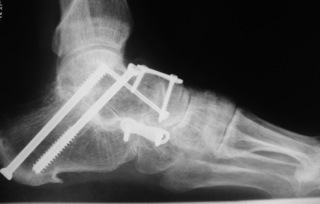 Current Insights On Internal Fixation Of Subtalar Fusions