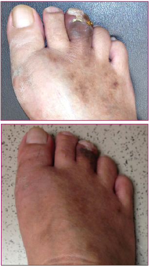 Current Concepts In Managing Chronic Gout