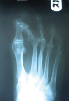 A Closer Look At Tendon Transfers For Crossover Hammertoe