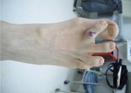 A Closer Look At Tendon Transfers For Crossover Hammertoe