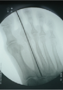 A Closer Look At Tendon Transfers For Crossover Hammertoe