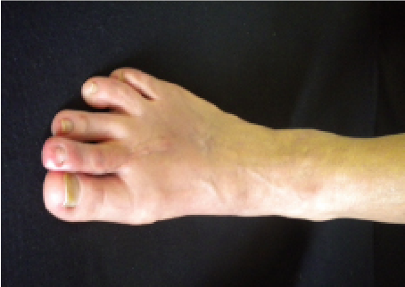 A Closer Look At Tendon Transfers For Crossover Hammertoe