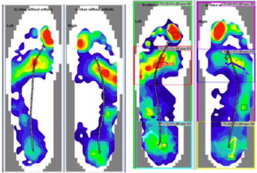 Exploring The Potential Of In-Shoe Pressure Analysis In Runners