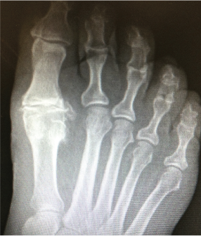 Emerging Insights On The First MPJ Arthrodesis