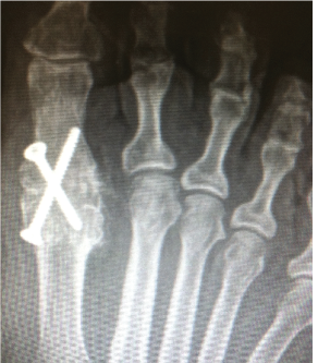 Emerging Insights On The First MPJ Arthrodesis