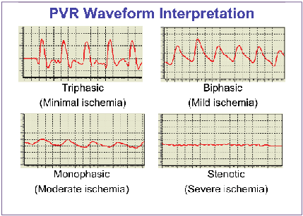 Dorsalis Pedis Perfusion