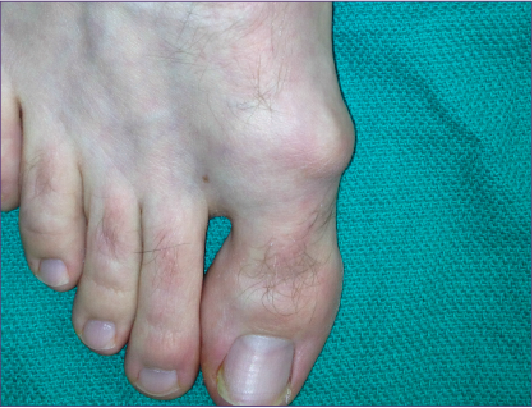Hallux Rigidus