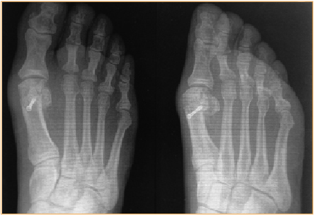 An Emerging Option For Treating Severely Subluxed Lesser MPJ ...