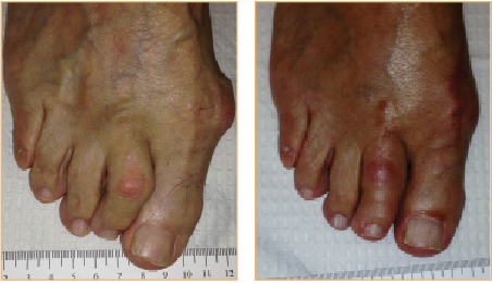 An Emerging Option For Treating Severely Subluxed Lesser MPJ ...