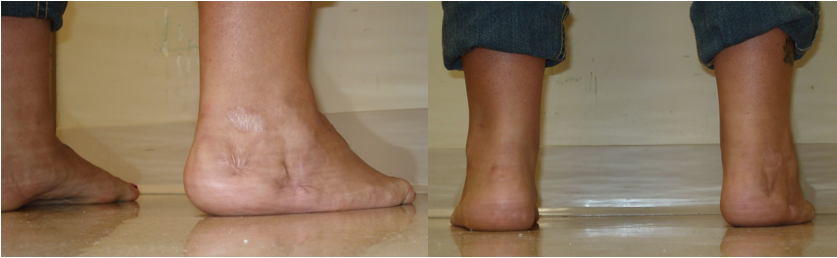 Treating Iatrogenic Calcaneal Osteomyelitis Following A Plantar Heel ...