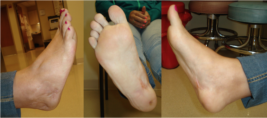 Treating Iatrogenic Calcaneal Osteomyelitis Following A Plantar Heel ...