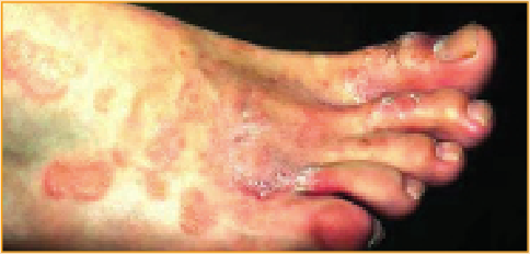 Antibiotic Rash