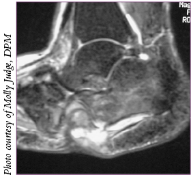 Osteomyelitis And Heel Ulcers: What You Should Know