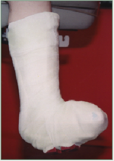 Transitioning From Open Wound To Final Footwear: Offloading The ...