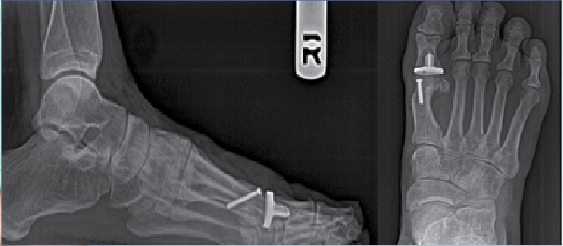First MPJ Arthrodesis: What The Evidence Reveals