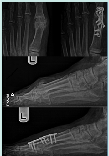 First MPJ Arthrodesis: What The Evidence Reveals