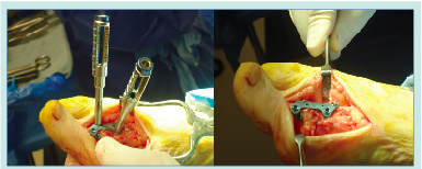 First MPJ Arthrodesis: What The Evidence Reveals