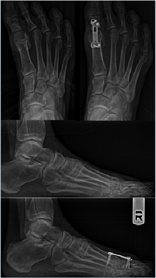 First MPJ Arthrodesis: What The Evidence Reveals