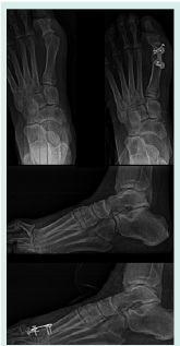 First MPJ Arthrodesis: What The Evidence Reveals