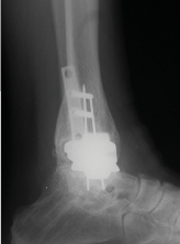 Emerging Insights With The Ankle Implant Arthroplasty