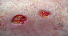 Current Concepts In Treating Puncture Wounds