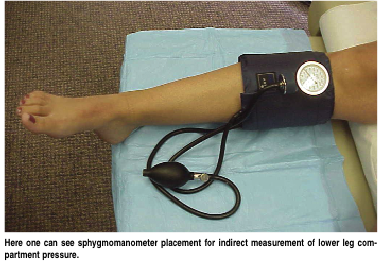 Treatments For Exertional Compartment Syndrome