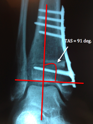 A Closer Look At The Distal Tibial Osteotomy For Ankle Varus
