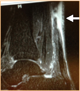 A Closer Look At Treatment Options For Neglected Achilles Tendon Ruptures